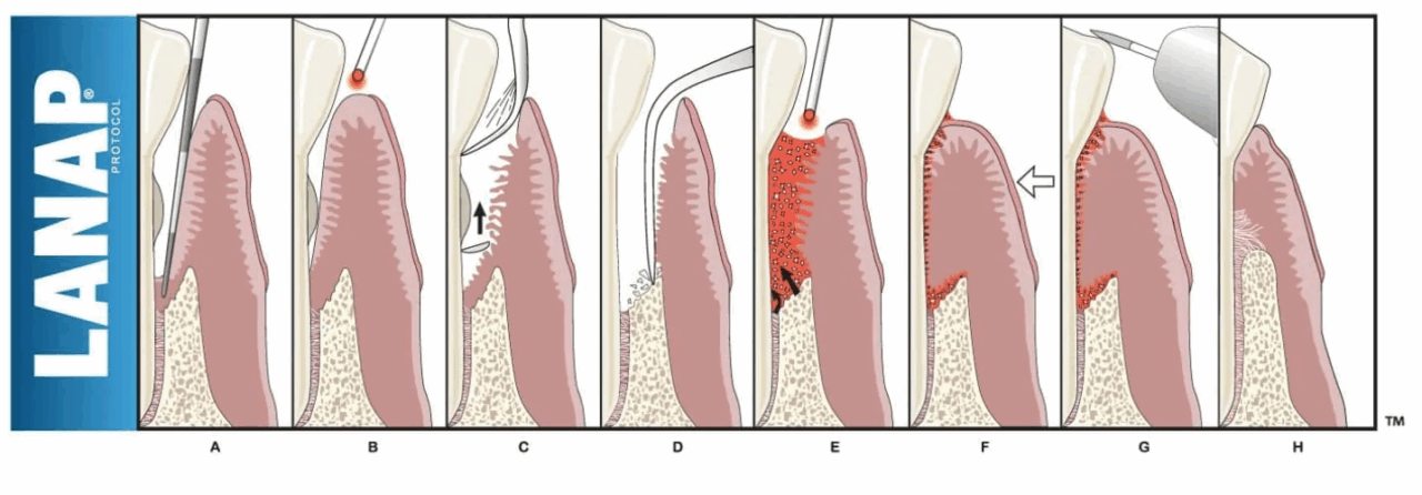 Laser Assisted Periodontal Therapy (LANAP) - Precision Periodontal and ...