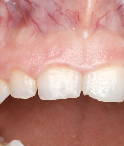 Crown Lengthening & Gingival Contouring - Precision Periodontal and ...